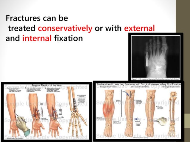 Traction ,cast and fixation | PPTX | Death, Injury, or Military ...