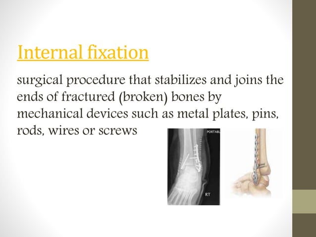 Traction ,cast and fixation | PPTX | Death, Injury, or Military ...