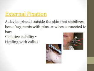 Traction ,cast and fixation | PPTX