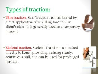 Traction ,cast and fixation | PPTX