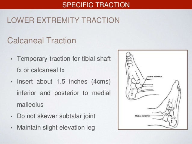 Traction in orthopaedic