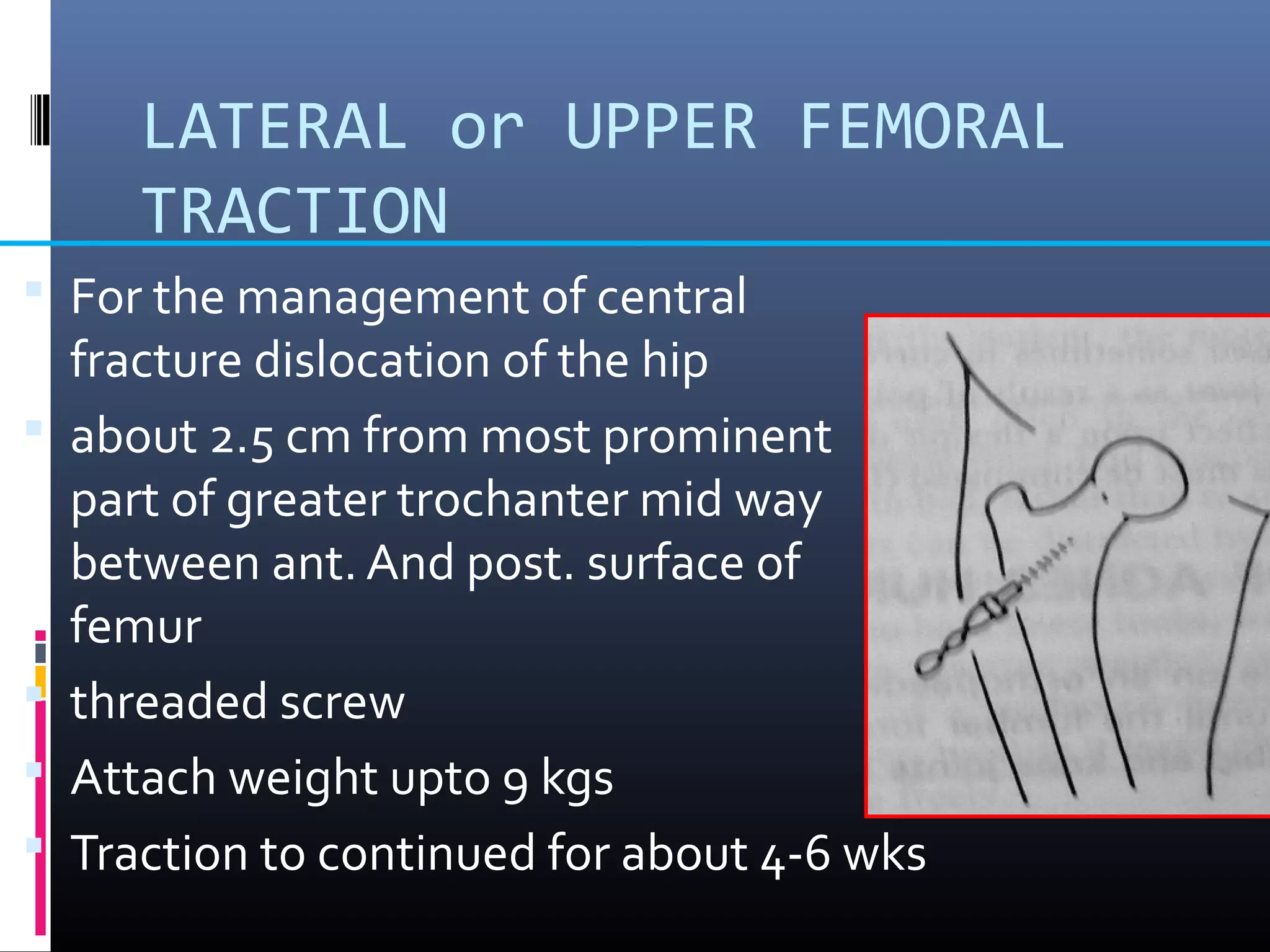 Traction in orthopaedics | PPT