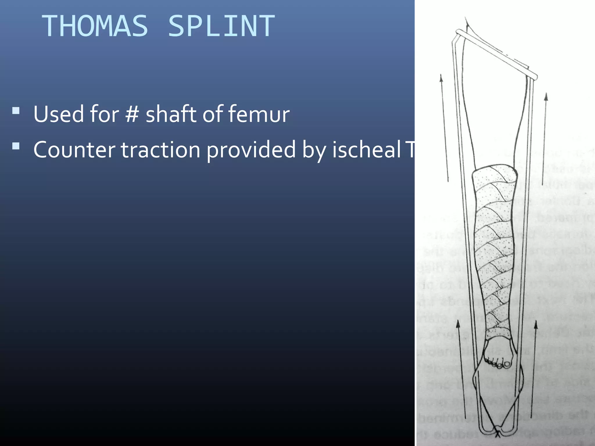 Traction in orthopaedics | PPT