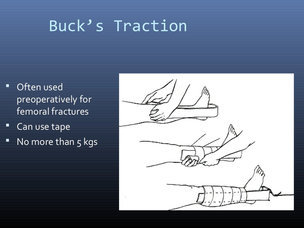 Traction in orthopaedics