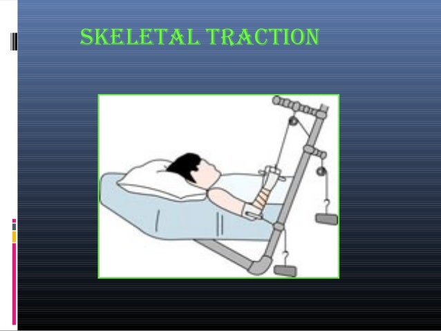 Traction in orthopaedics