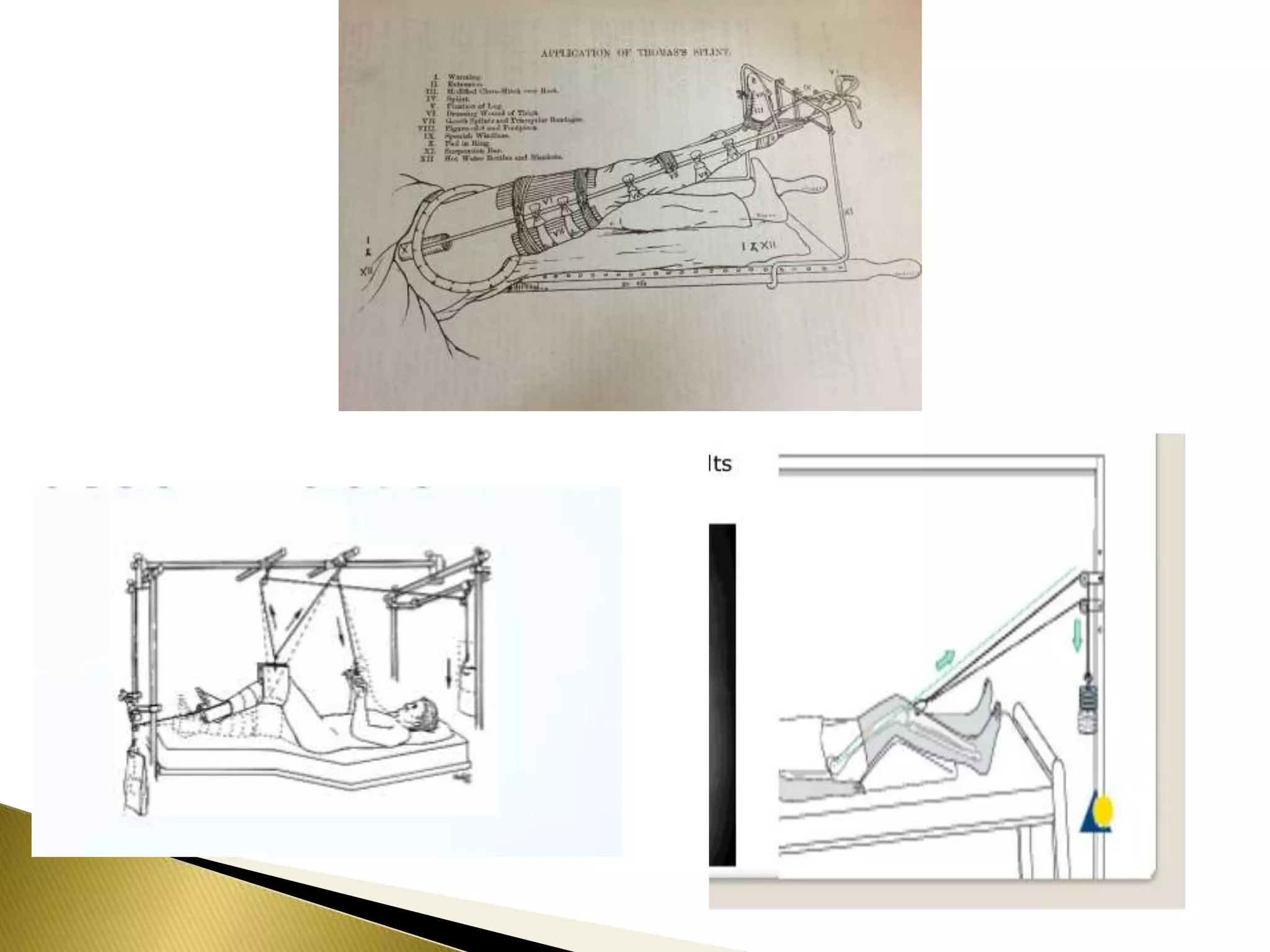 Traction in orthopaedics for ug mbbs | PPTX