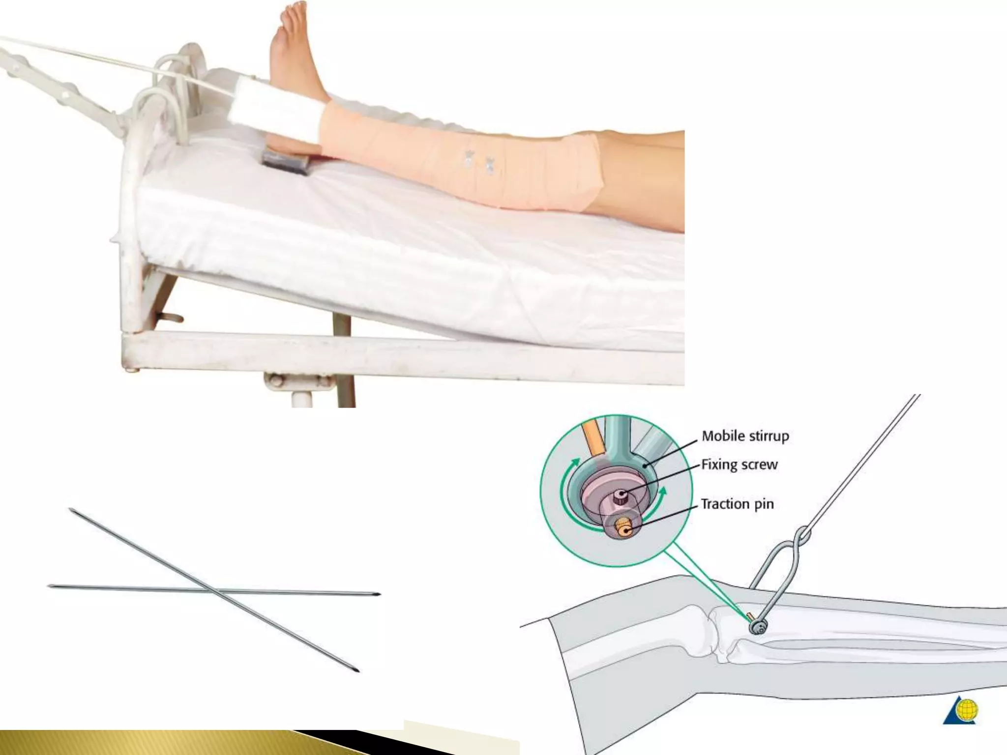 Traction in orthopaedics for ug mbbs | PPTX