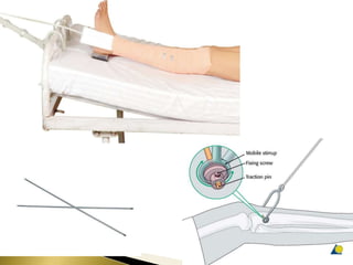 Traction in orthopaedics for ug mbbs | PPTX