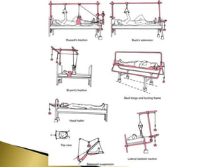 Traction in orthopaedics for ug mbbs | PPTX