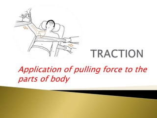 Traction in orthopaedics for ug mbbs | PPTX