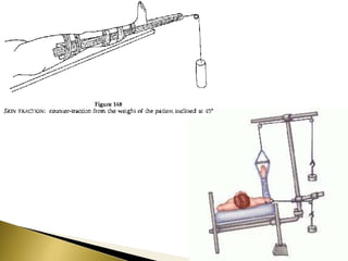 Traction in orthopaedics for ug mbbs | PPTX