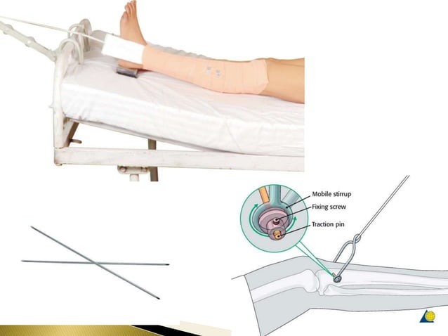Traction in orthopaedics for ug mbbs