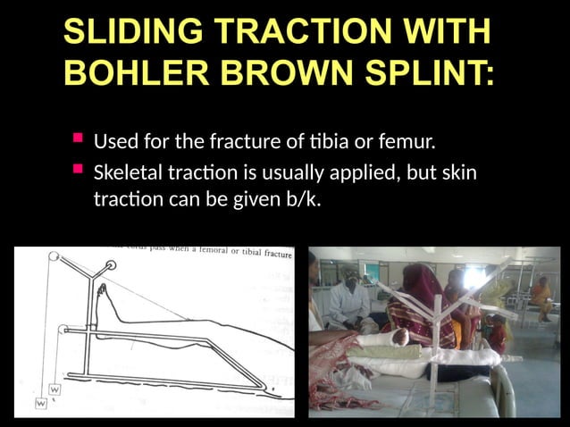 traction_in_orthopaedics and trauma medic | PPT