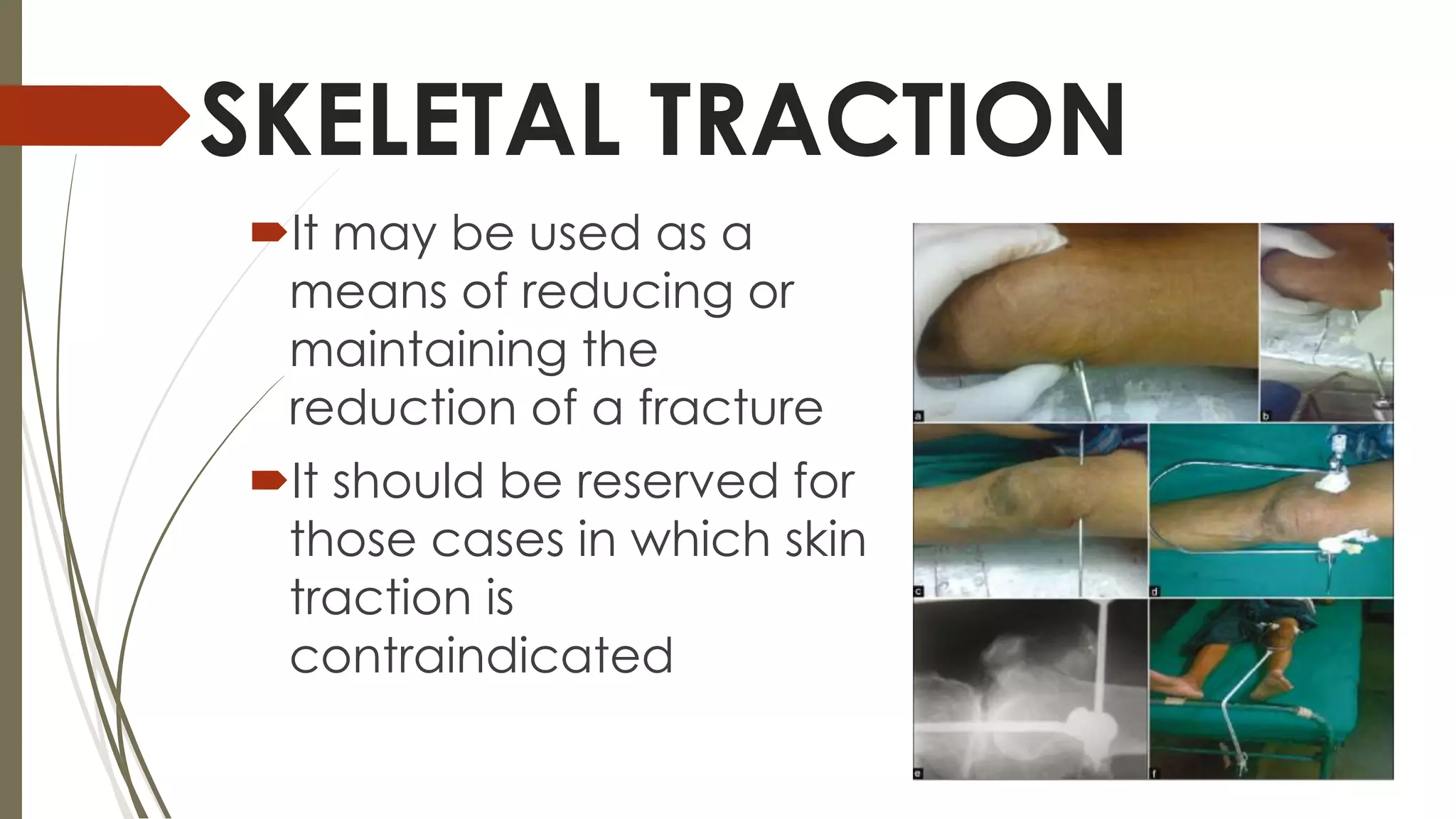 Traction(orthopedics) | PPTX