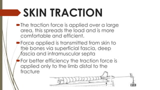 Traction(orthopedics) | PPTX