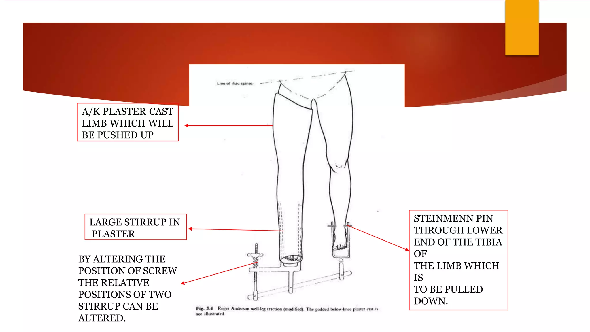 Lower Limb traction | PPTX