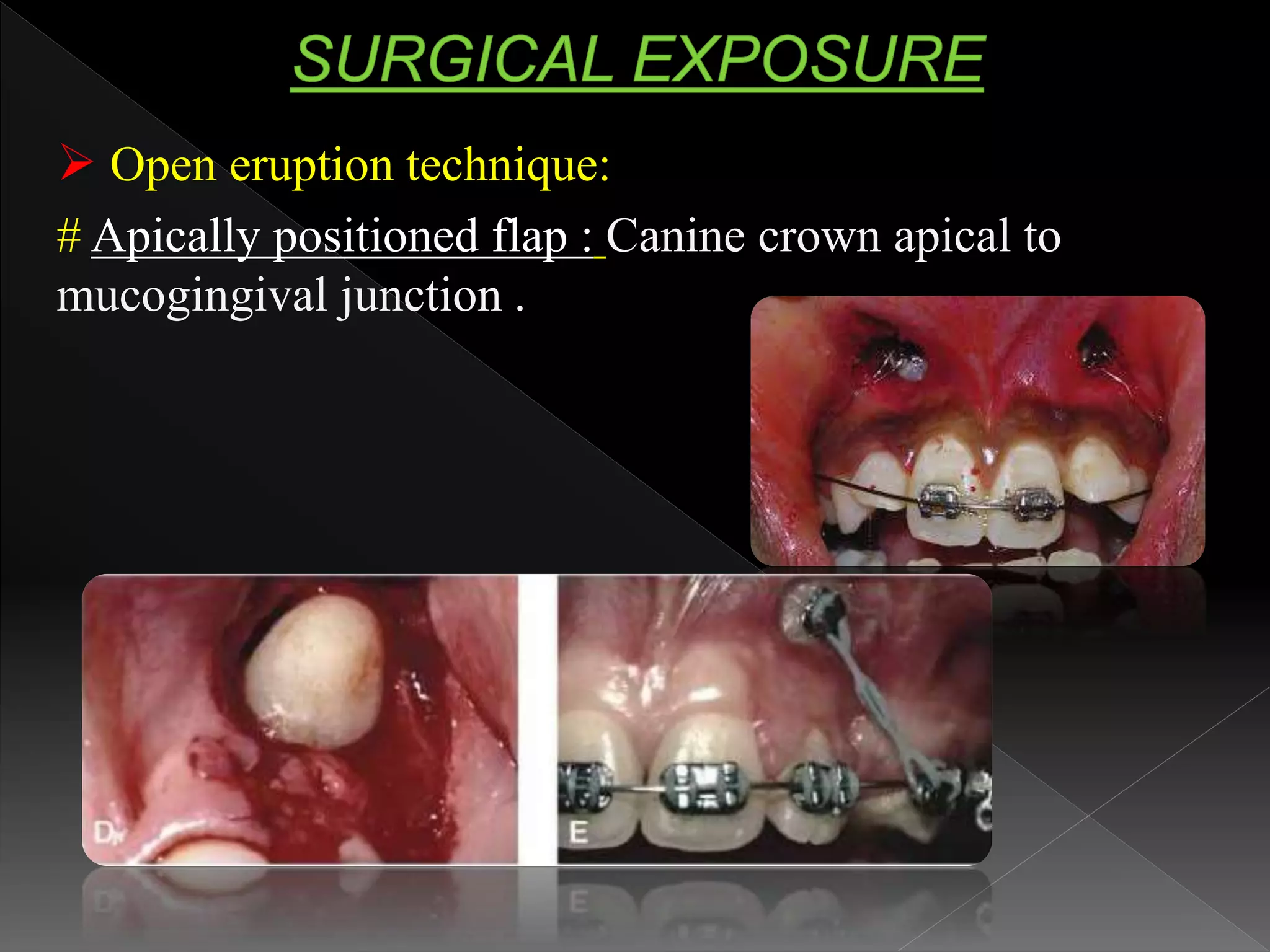 orthodonticTraction of impacted maxillary canine and Piggyback ...