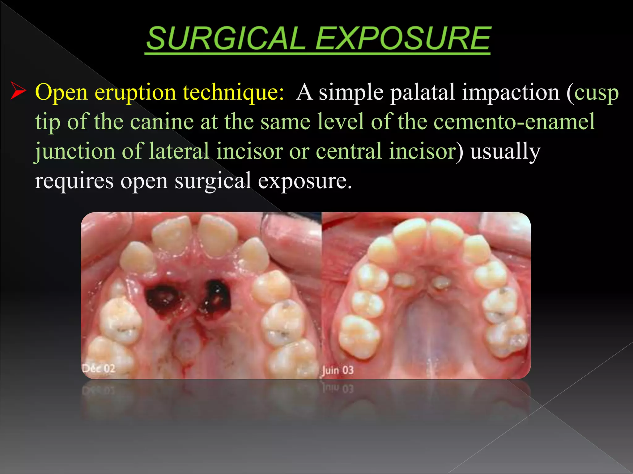 orthodonticTraction of impacted maxillary canine and Piggyback ...