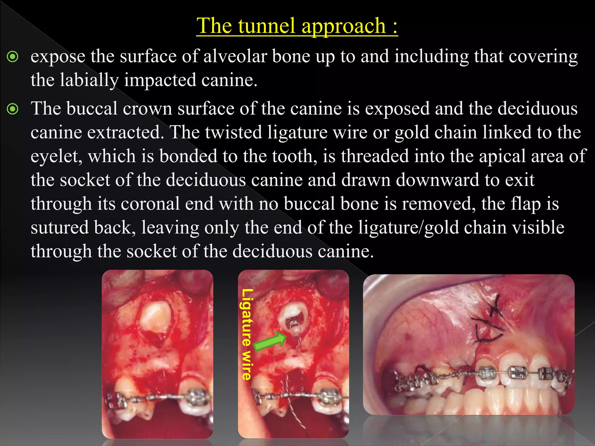 orthodonticTraction of impacted maxillary canine and Piggyback ...
