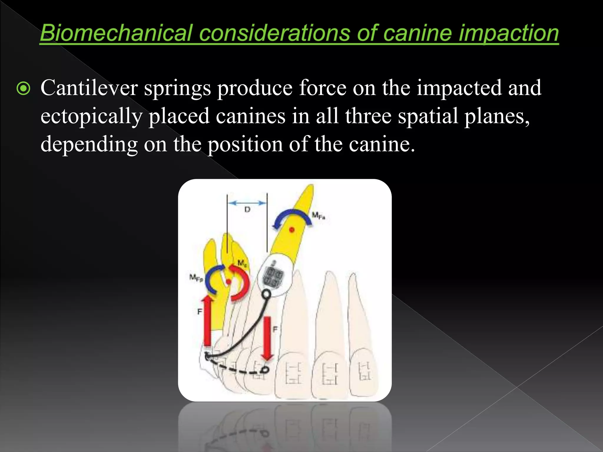 orthodonticTraction of impacted maxillary canine and Piggyback ...