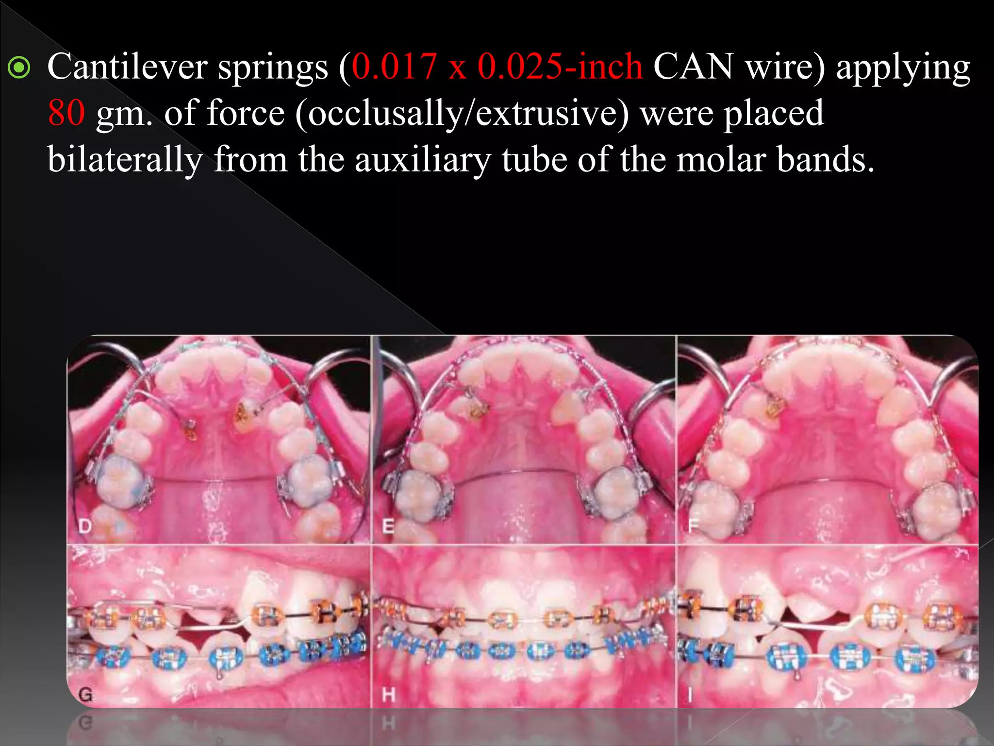 orthodonticTraction of impacted maxillary canine and Piggyback ...
