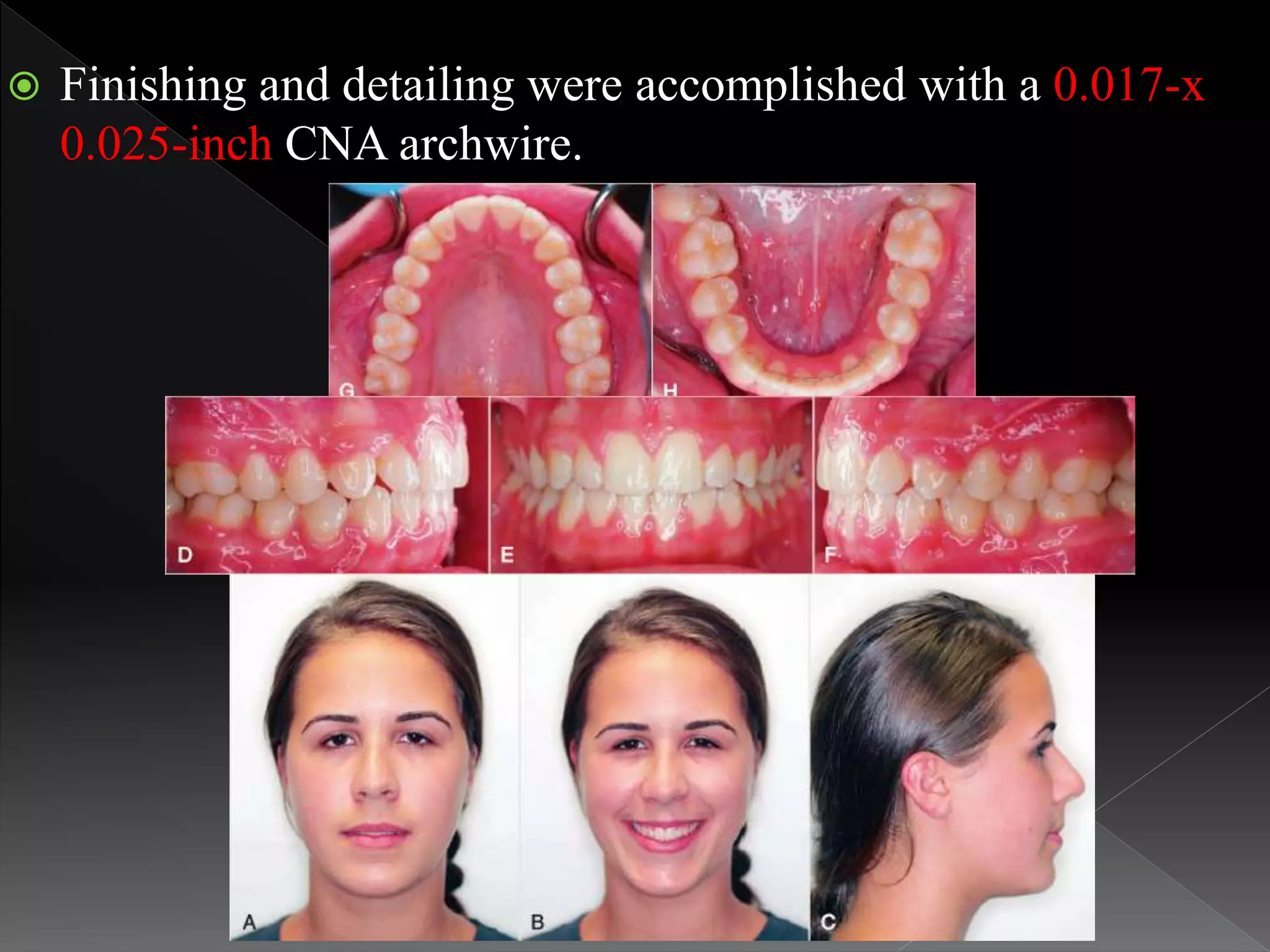 orthodonticTraction of impacted maxillary canine and Piggyback ...