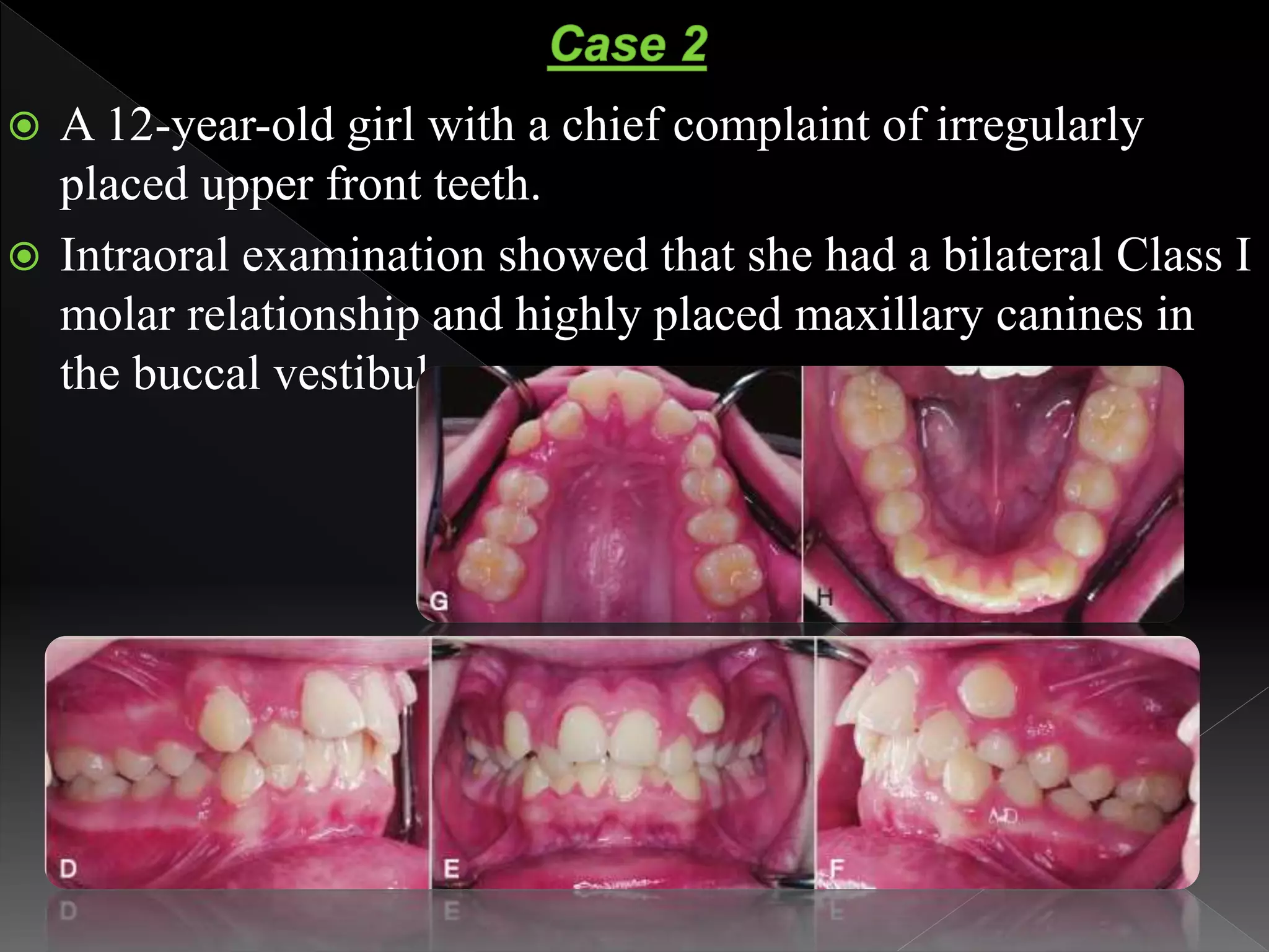 orthodonticTraction of impacted maxillary canine and Piggyback ...