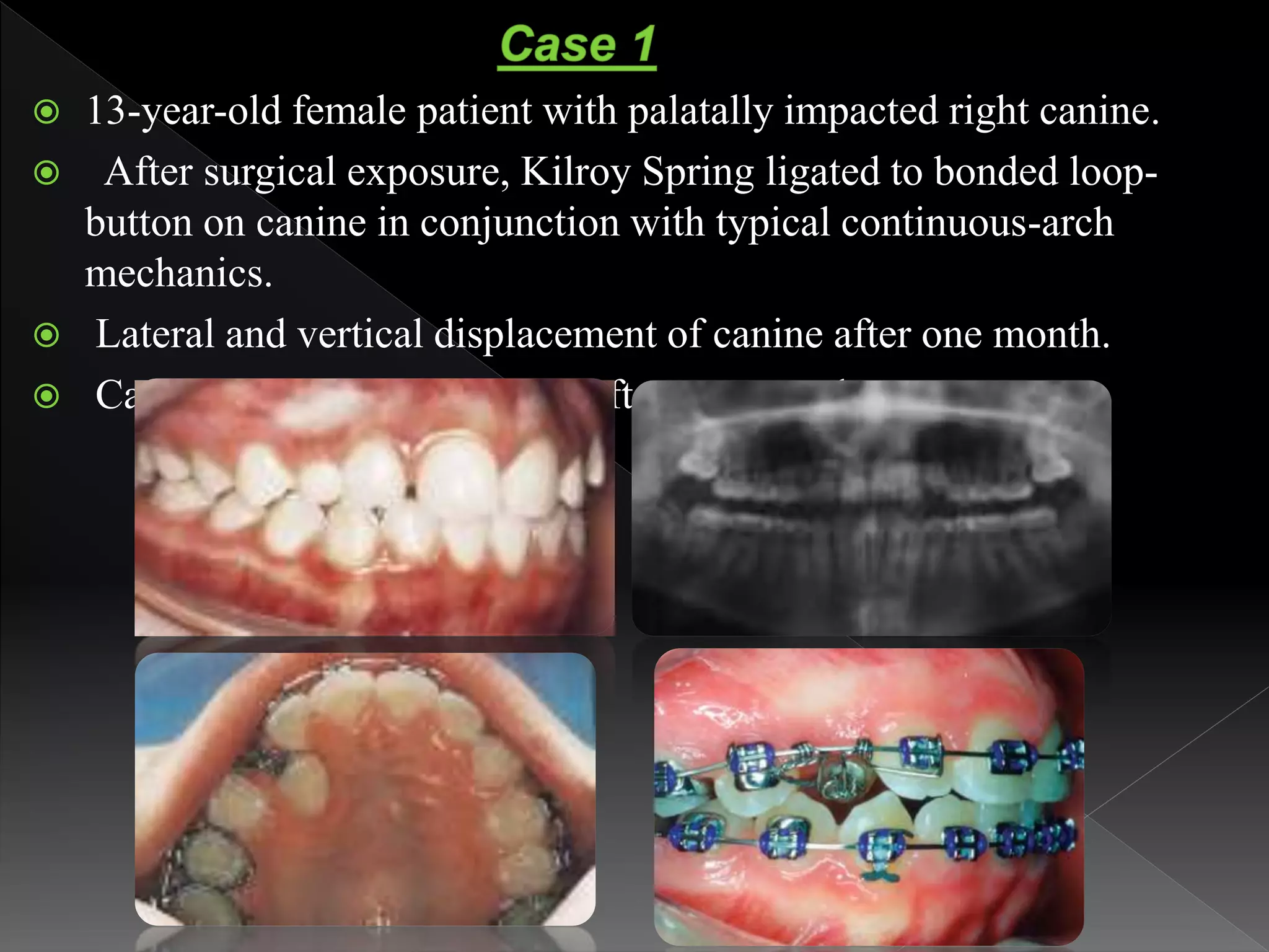 orthodonticTraction of impacted maxillary canine and Piggyback ...