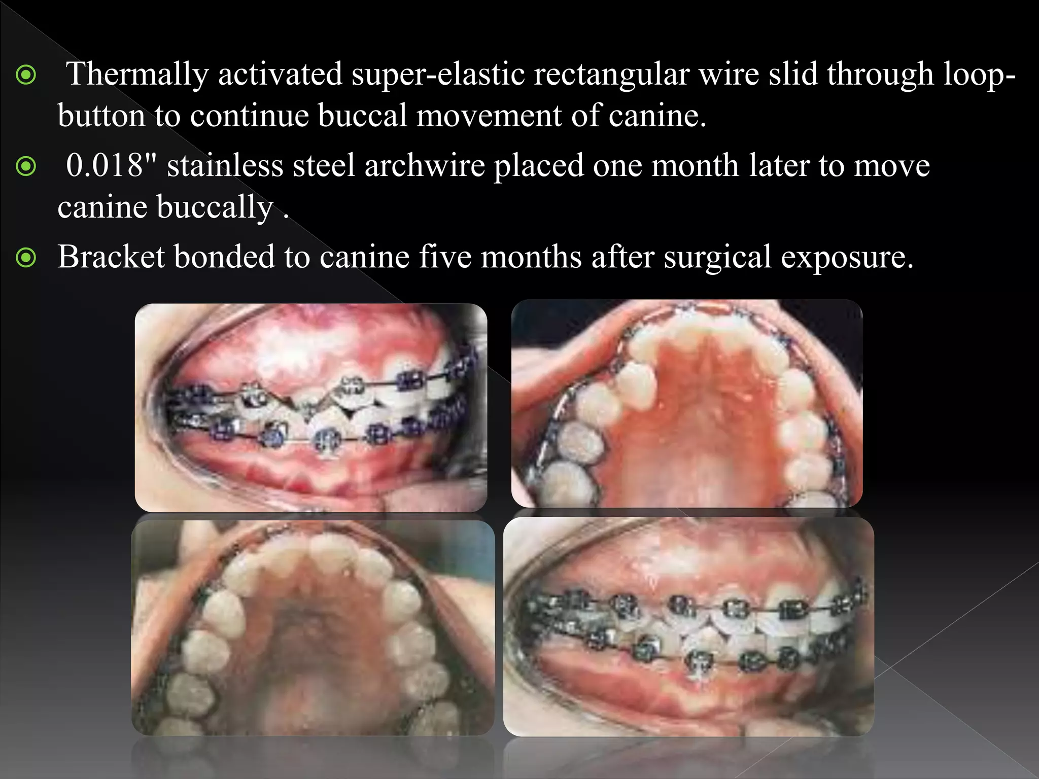 orthodonticTraction of impacted maxillary canine and Piggyback ...