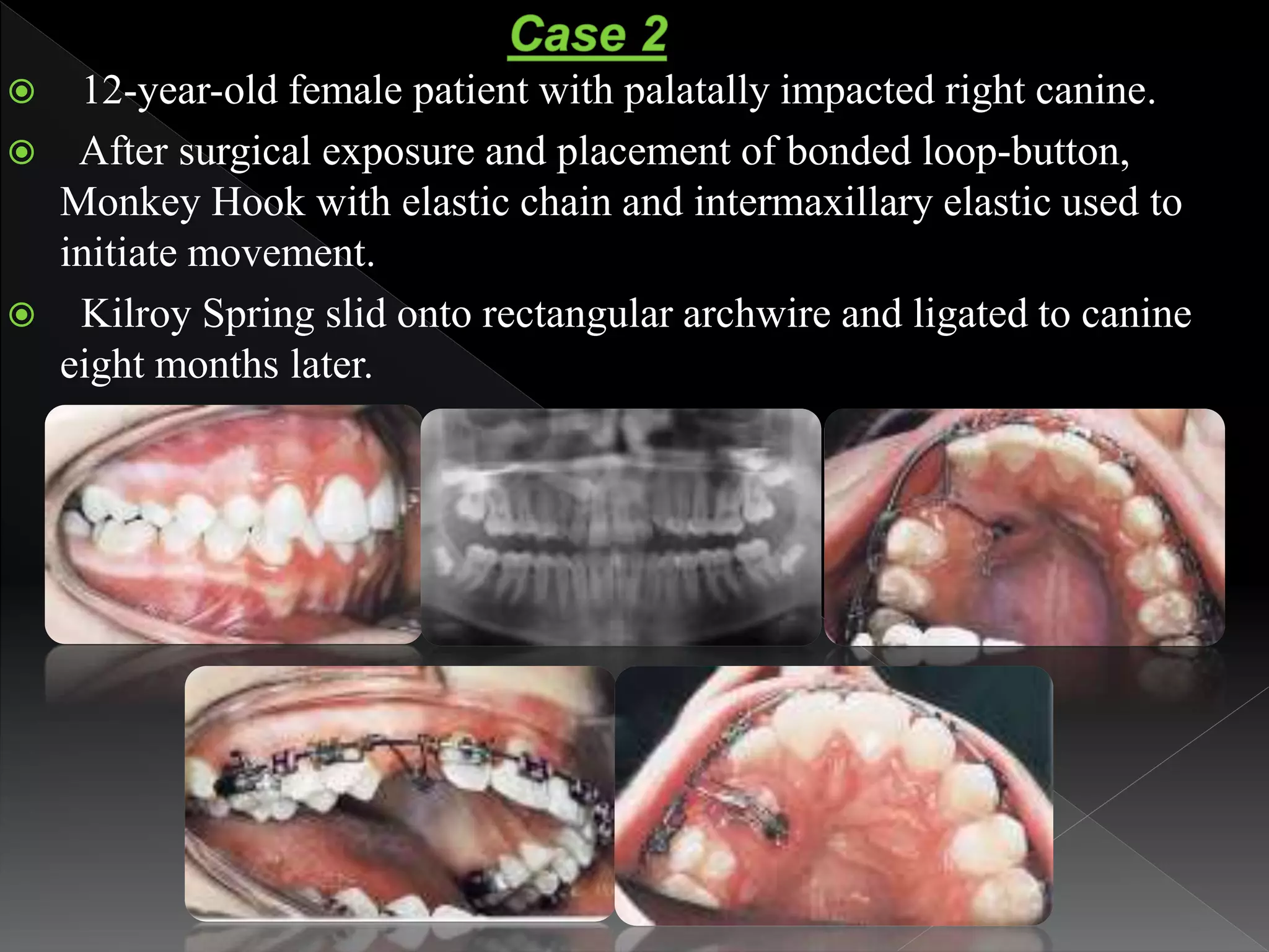 orthodonticTraction of impacted maxillary canine and Piggyback ...