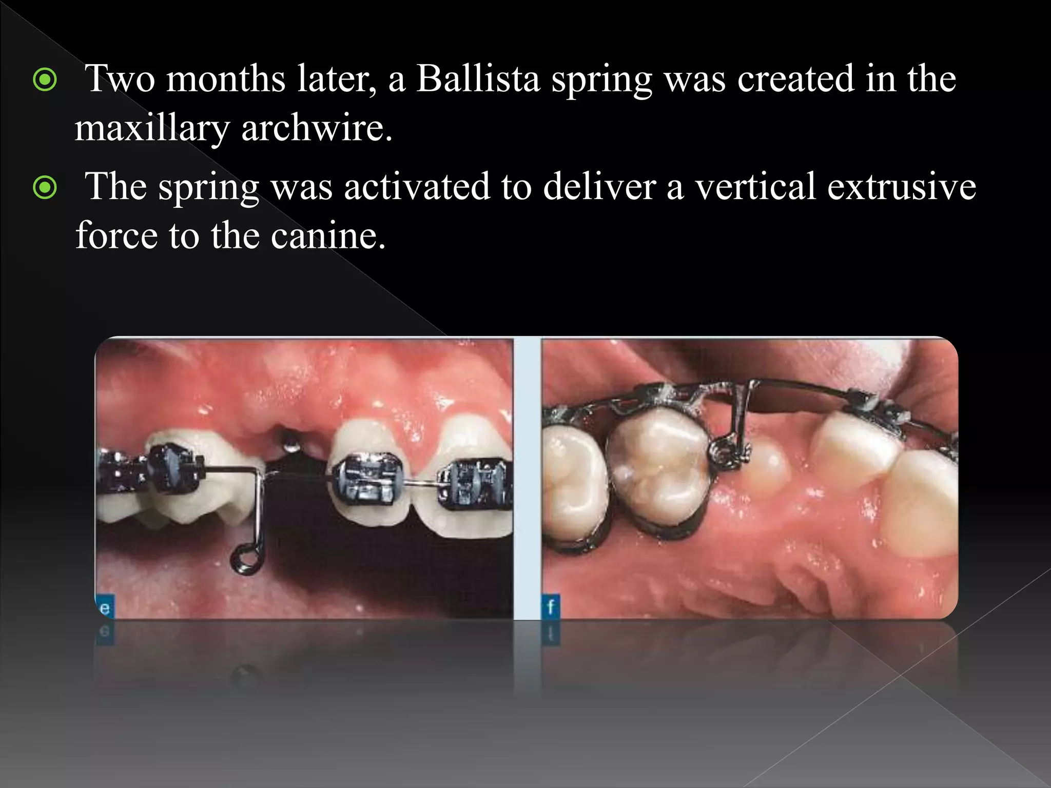 orthodonticTraction of impacted maxillary canine and Piggyback ...