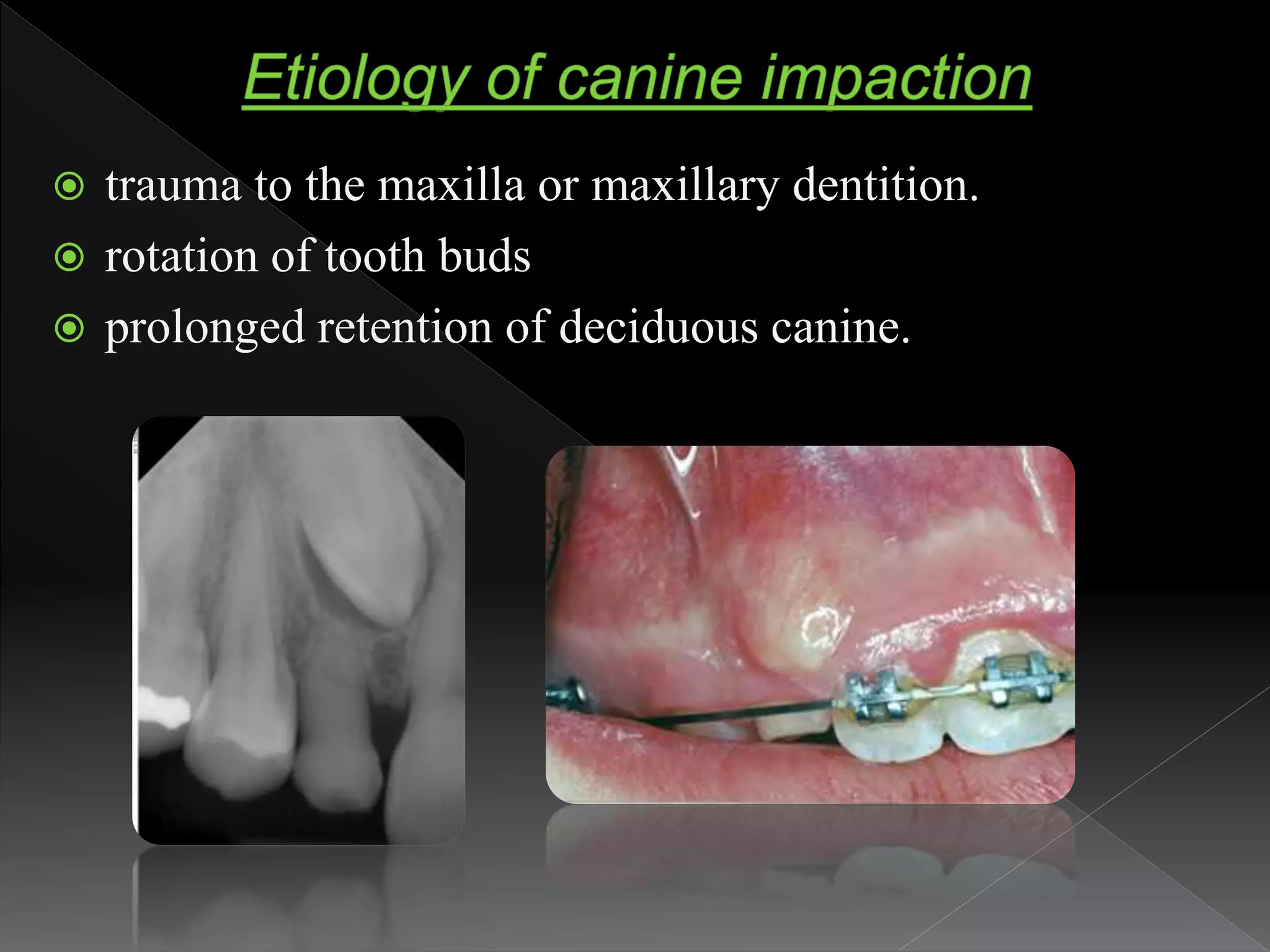 orthodonticTraction of impacted maxillary canine and Piggyback ...