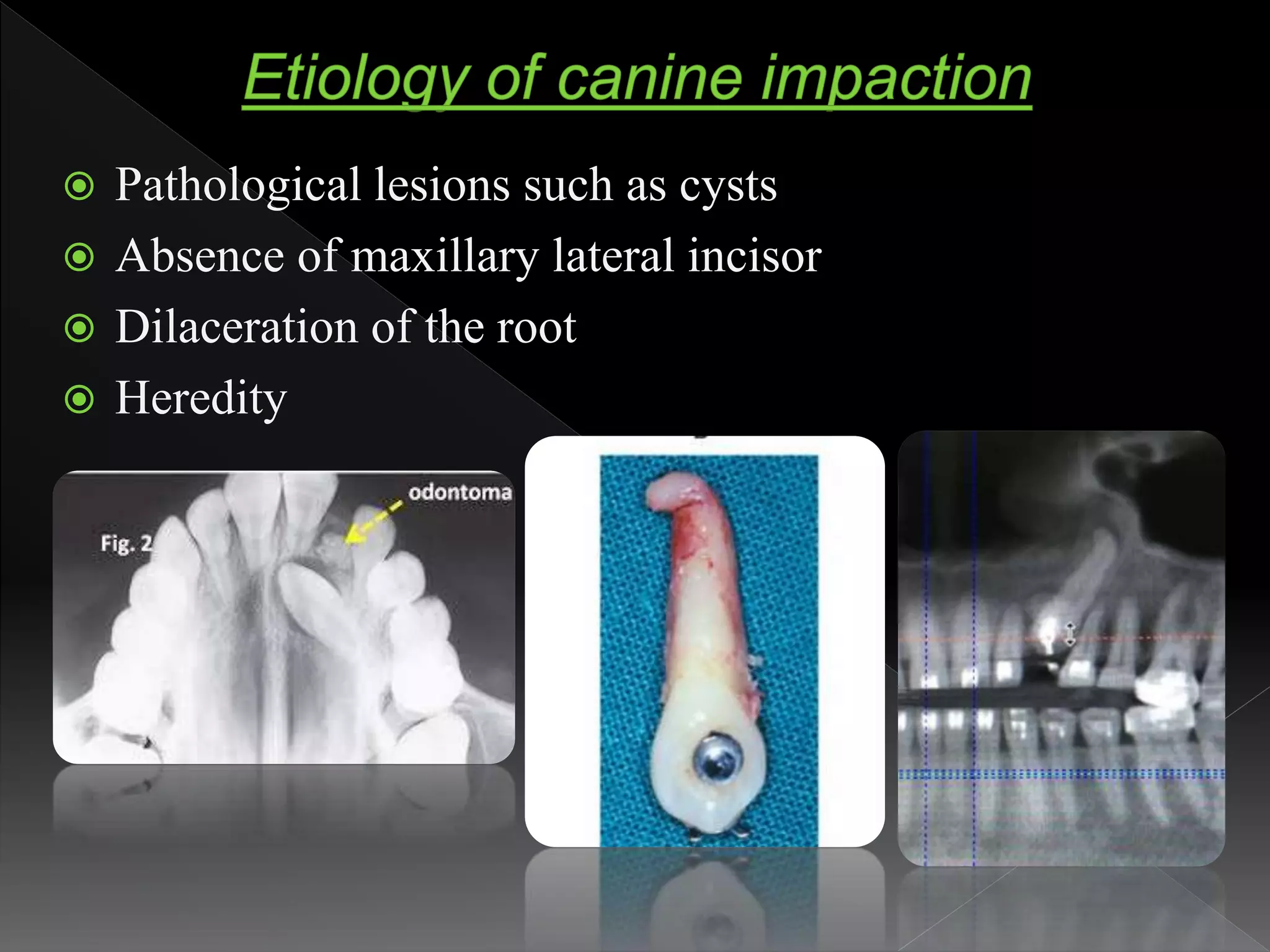 orthodonticTraction of impacted maxillary canine and Piggyback ...
