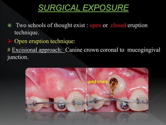 orthodonticTraction of impacted maxillary canine and Piggyback ...