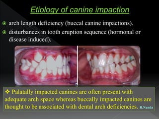 orthodonticTraction of impacted maxillary canine and Piggyback ...