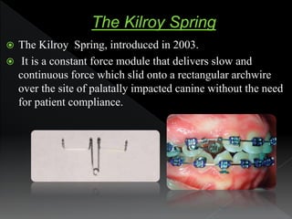 orthodonticTraction of impacted maxillary canine and Piggyback ...