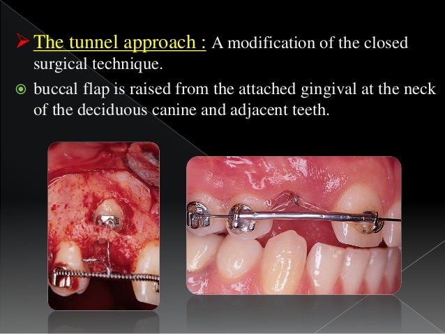 orthodonticTraction of impacted maxillary canine and Piggyback techni…