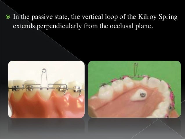 orthodonticTraction of impacted maxillary canine and Piggyback techni…