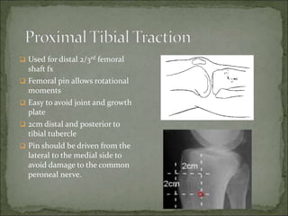 Tractions | PPT