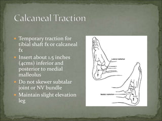 Tractions | PPT
