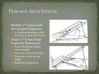 Thomas Splint And Pearson Attachment