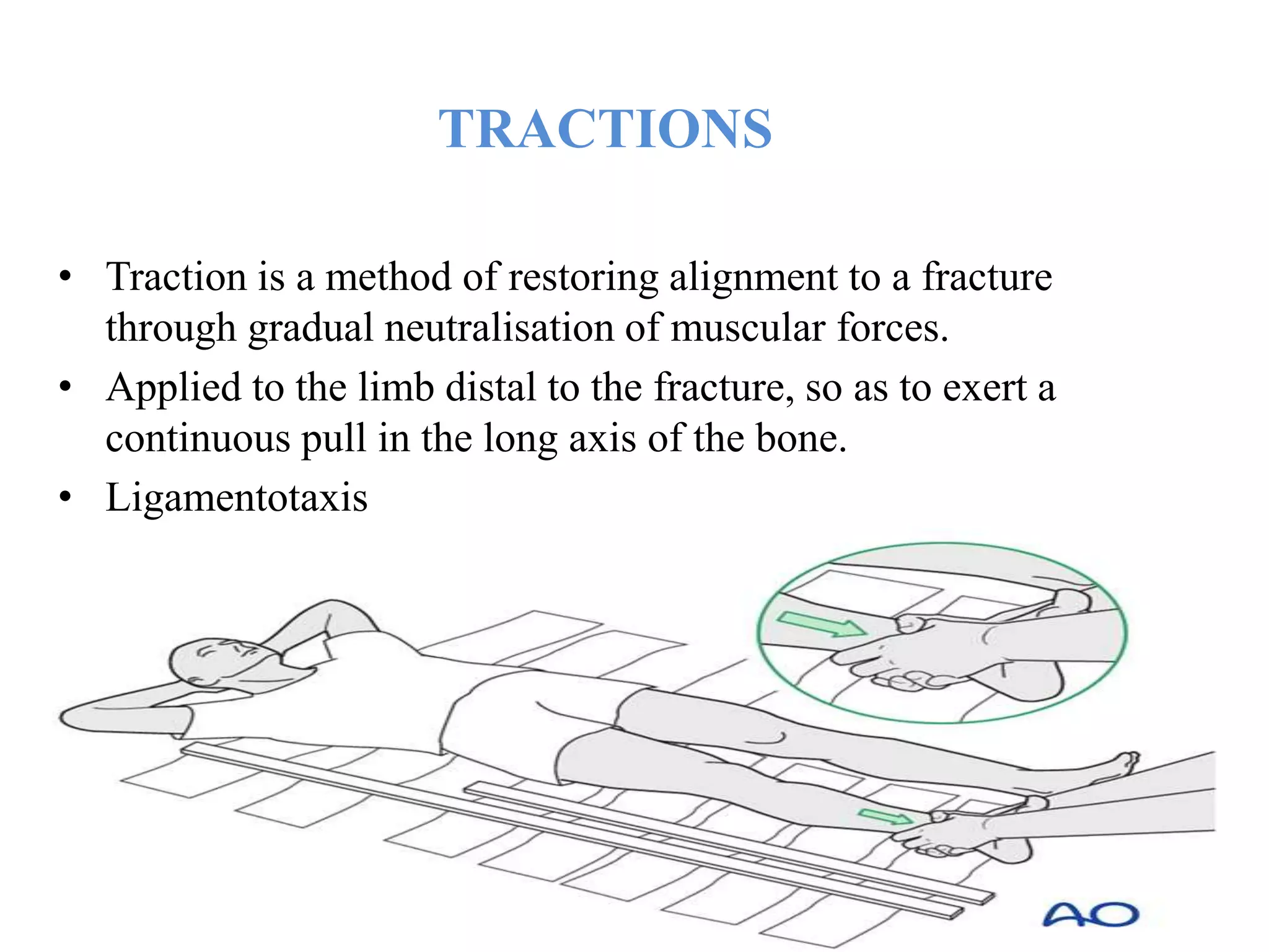 Tractions in Orthopaedics.ppt