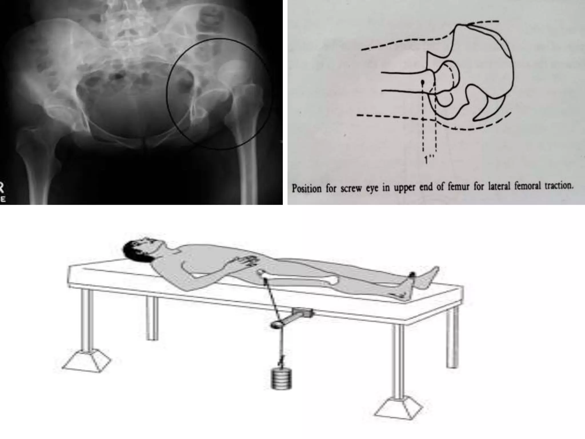 Tractions in Orthopaedics.ppt