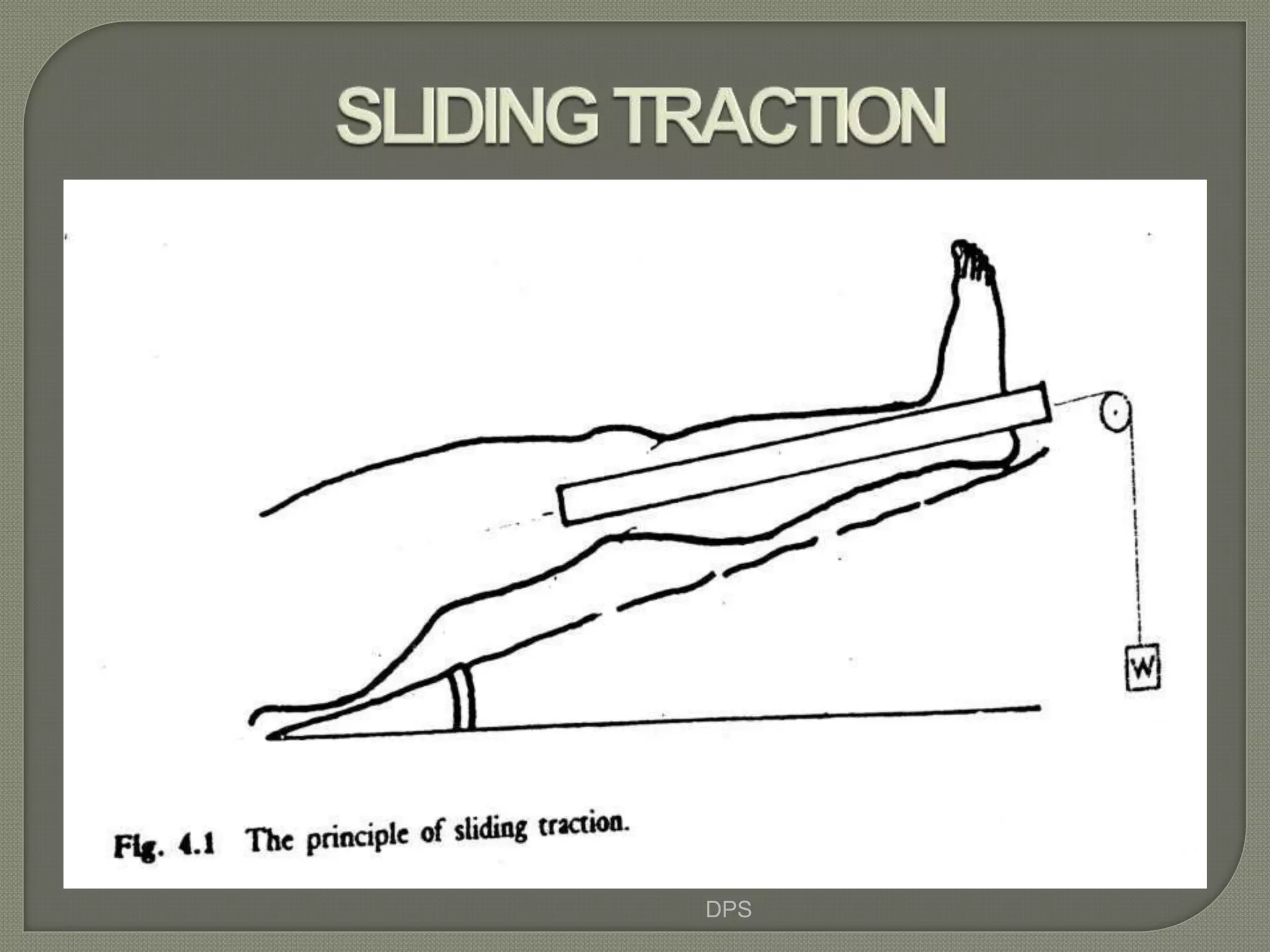 Tractions in orthopaedics by dr. d. p. swami | PPT
