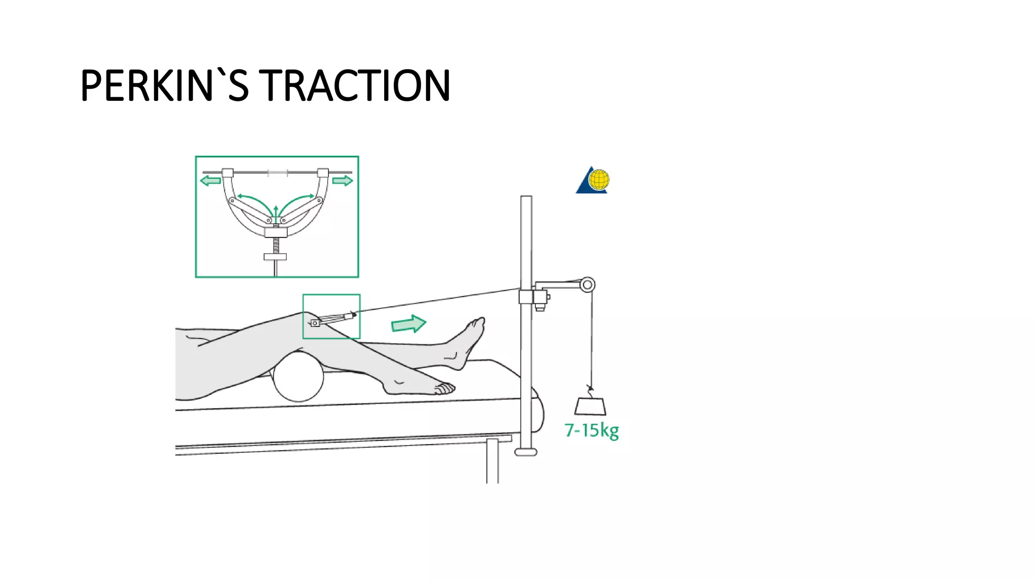 Tractions in orthopaedics by Dr O.O. Afuye | PPTX