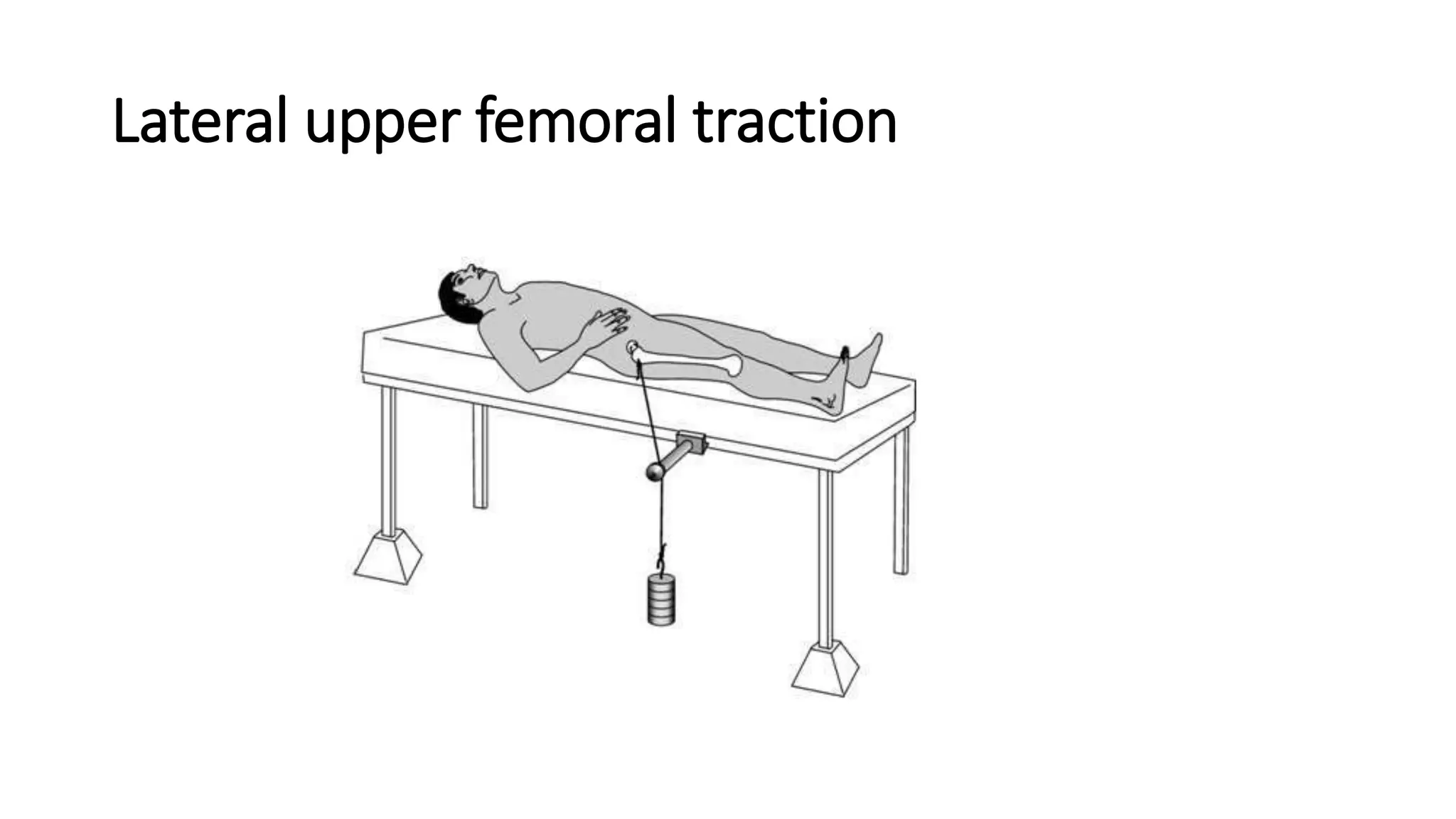 Tractions in orthopaedics by Dr O.O. Afuye | PPTX