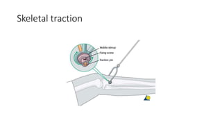 Tractions in orthopaedics by Dr O.O. Afuye | PPTX