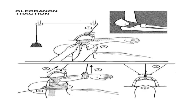 Tractions in orthopaedics by Dr O.O. Afuye | PPTX
