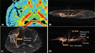 Tractografía cerebral | PPT
