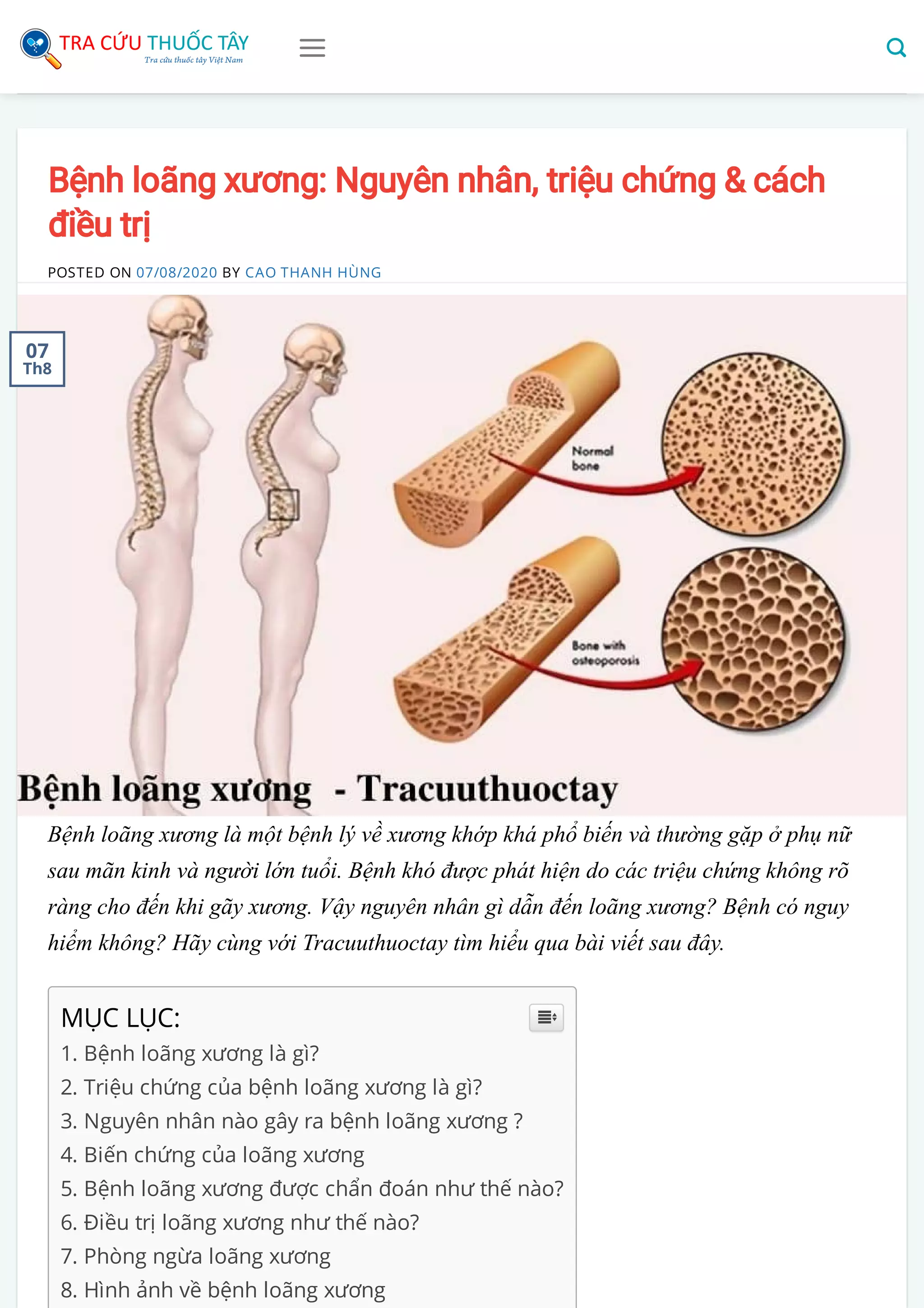 Benh loang xuong Nguyen nhan trieu chung cach dieu tri | Tracuuthuoctay | PDF